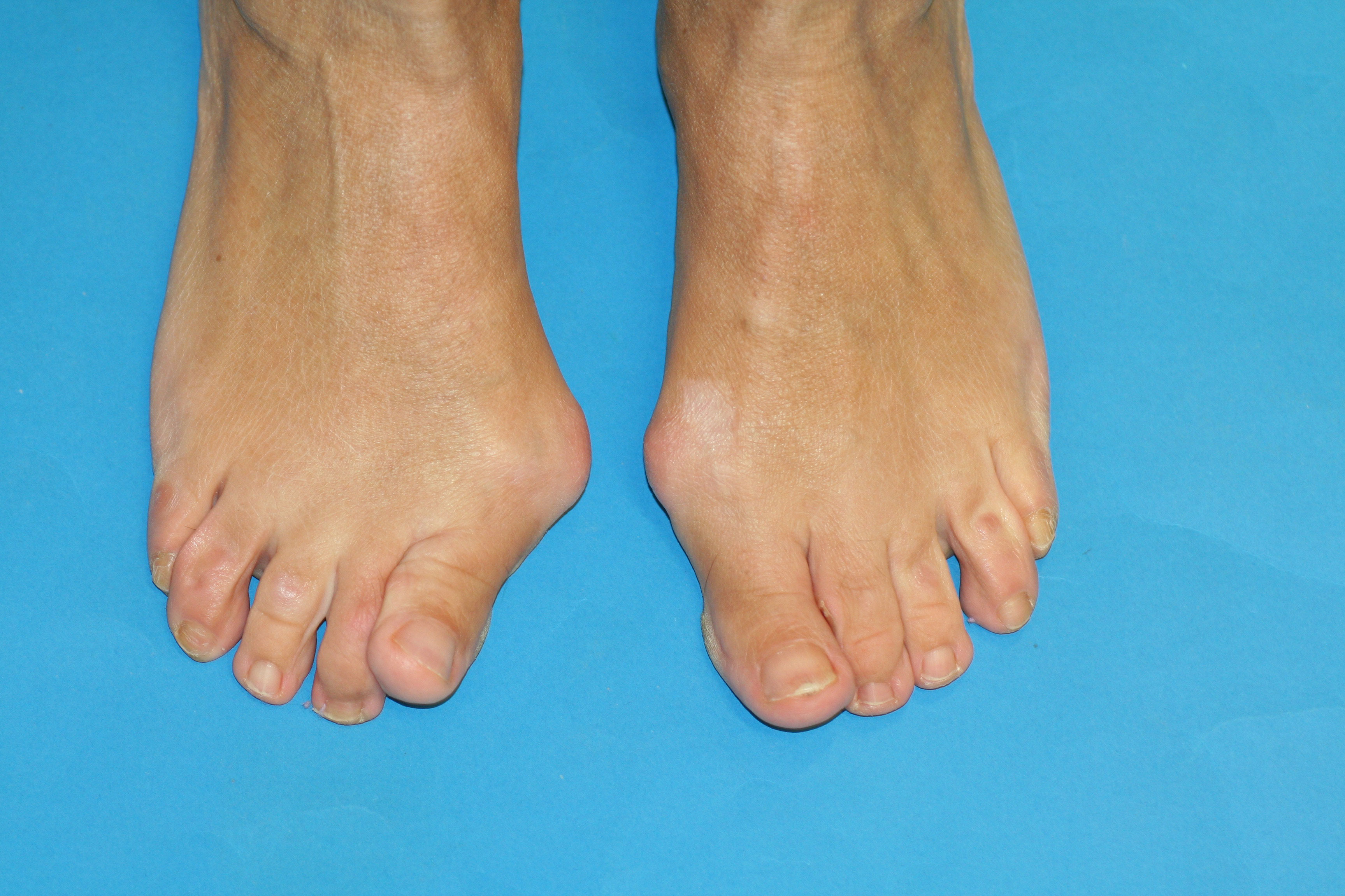 Hallux-Valgus-o-Juanete-2 | Clínica María del Mar Ruiz