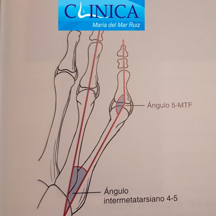 Juanete de Sastre o Quintus Varus. Sus causas, Síntomas y Tratamiento