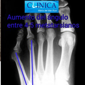 Juanete De Sastre O Quintus Varus Sus Causas Síntomas Y Tratamiento