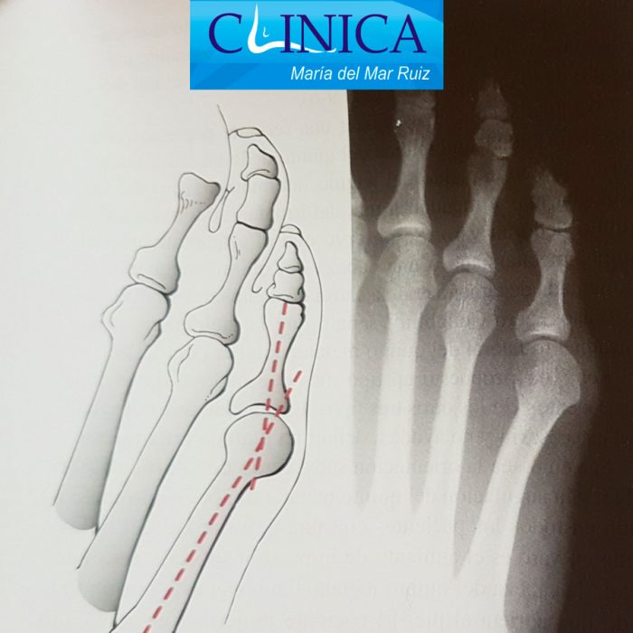 Juanete de Sastre o Quintus Varus. Sus causas, Síntomas y Tratamiento