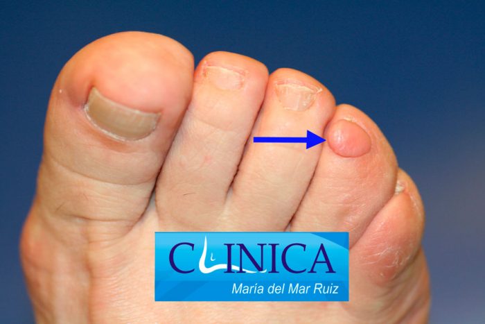 Uña Incarnada. Causas, Síntomas y Tratamiento