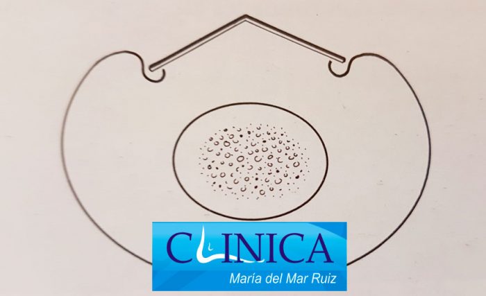 Uña Incarnada. Causas, Síntomas y Tratamiento