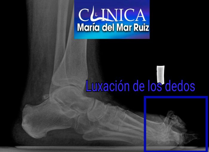 Pie Reumático Artritis Reumatoide