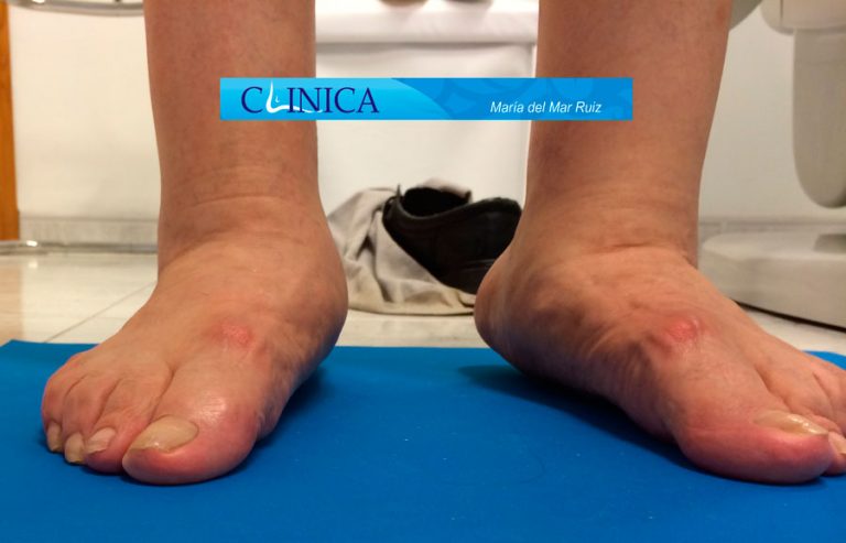 Pie Reumático Artritis Reumatoide