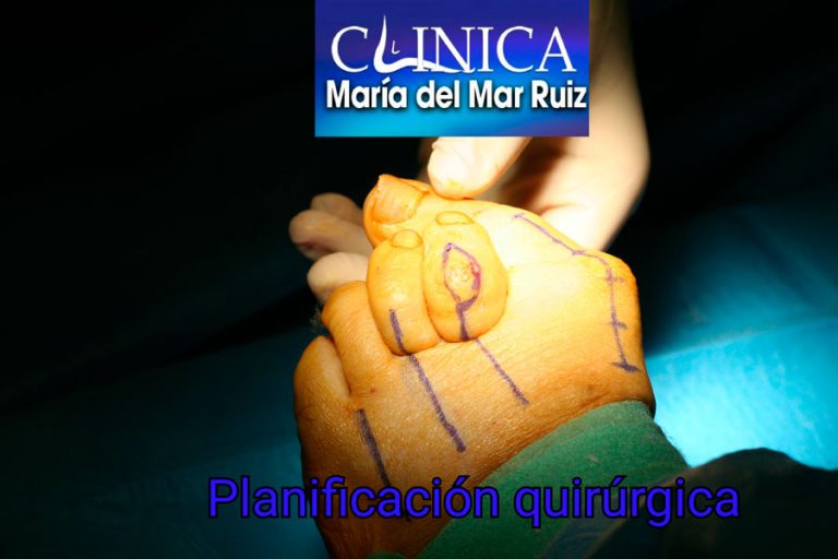 Pie Reumático Artritis Reumatoide