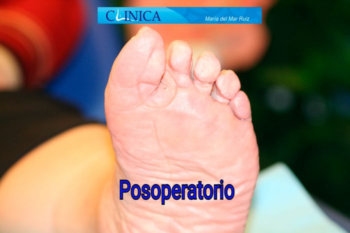 Pie Reumático Artritis Reumatoide