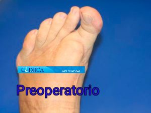 Pie Reumático Artritis Reumatoide