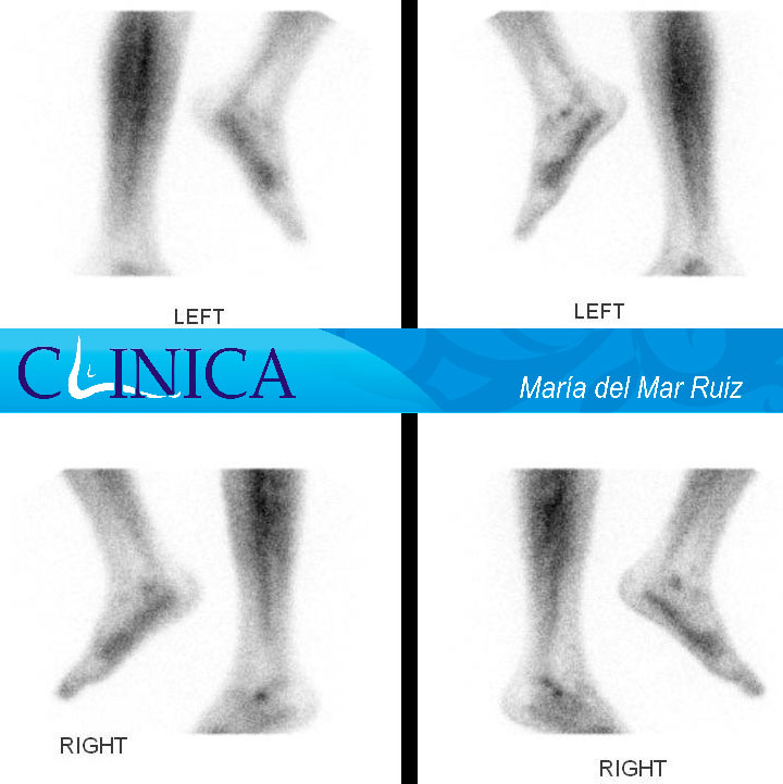 Pie Reumático Artritis Reumatoide
