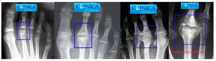 Enfermedad de Freiberg. Qué es, causas, síntomas y tratamiento