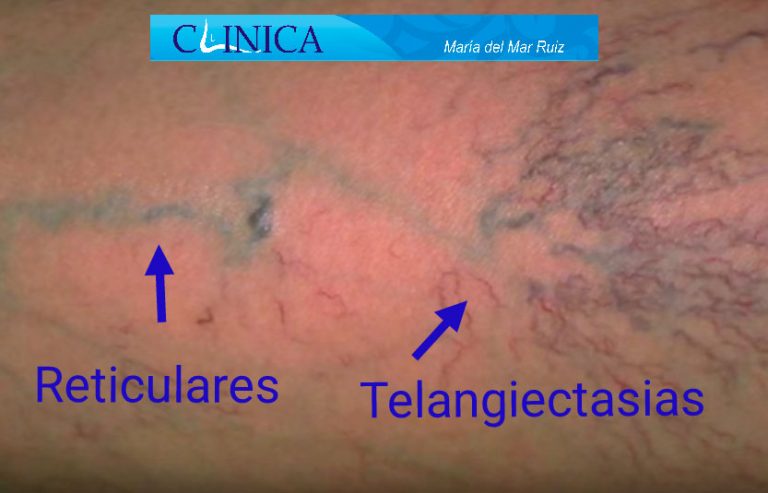 Varices y Telangiectasias: Escleroterapia