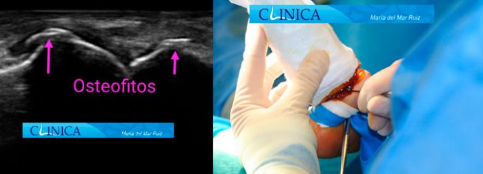 Heloma Interdigital Ojo de Gallo Heloma Molle. Síntomas y Tratamiento