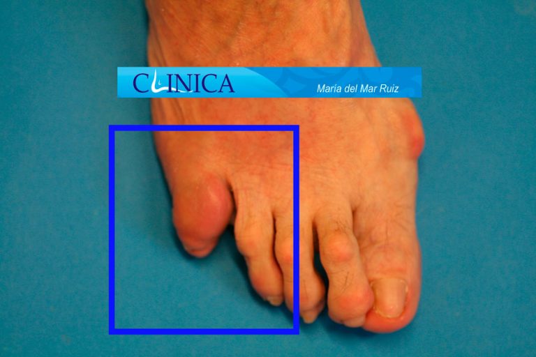 Heloma Interdigital Ojo de Gallo Heloma Molle. Síntomas y Tratamiento