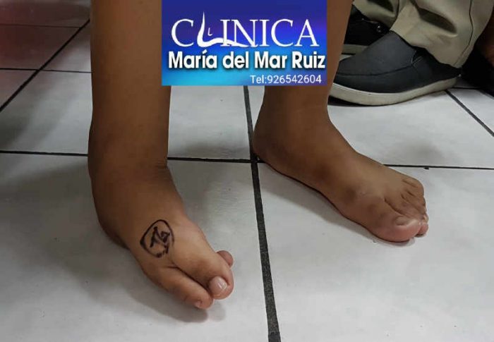 Pie Equino Varo o Pie Zambo