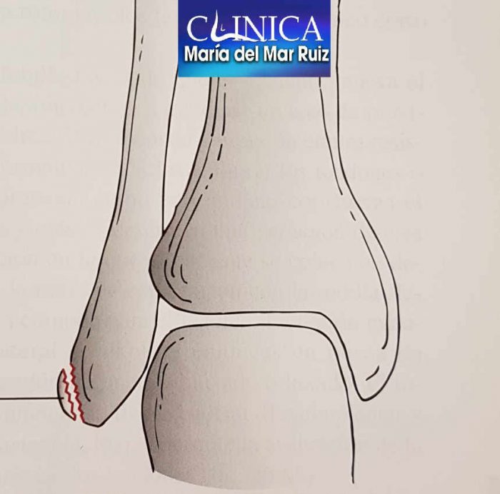 Luxación, Desgarros, Roturas de los Tendones Peroneos