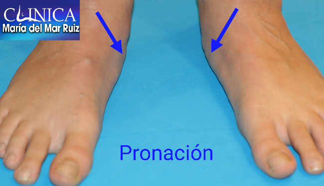 Pie Plano en el Niño