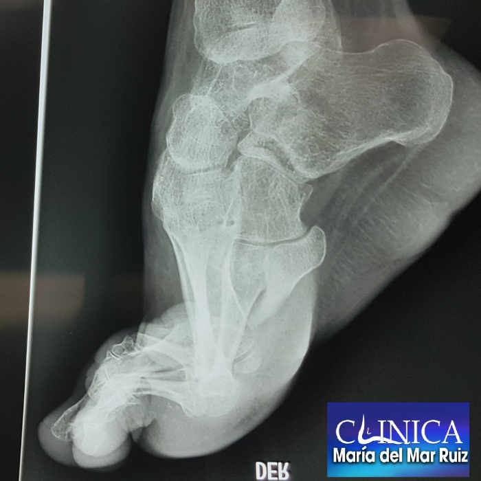 Anatomía De La Radiografía Lateral Del Pie Biomecánica Del Pie Cavo