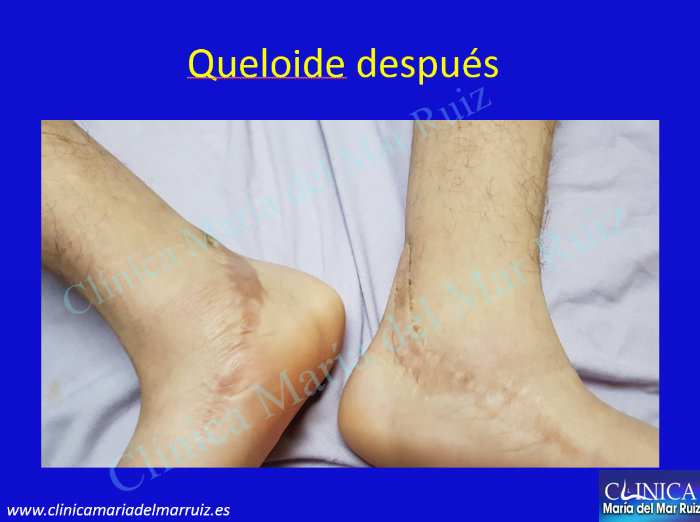 Queloides y Postcirugía de Queloide