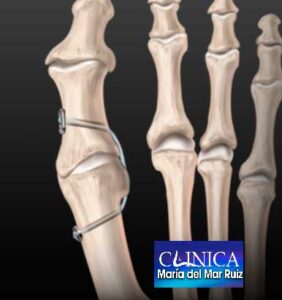 Hallux Varus. Causas, Síntomas y Tratamiento» Clínica María del Mar Ruiz